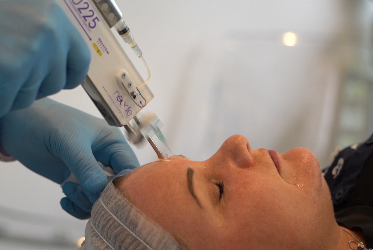 Mesotherapy for Skin Hydration (MesoLift) - SkinMedico Clinic London