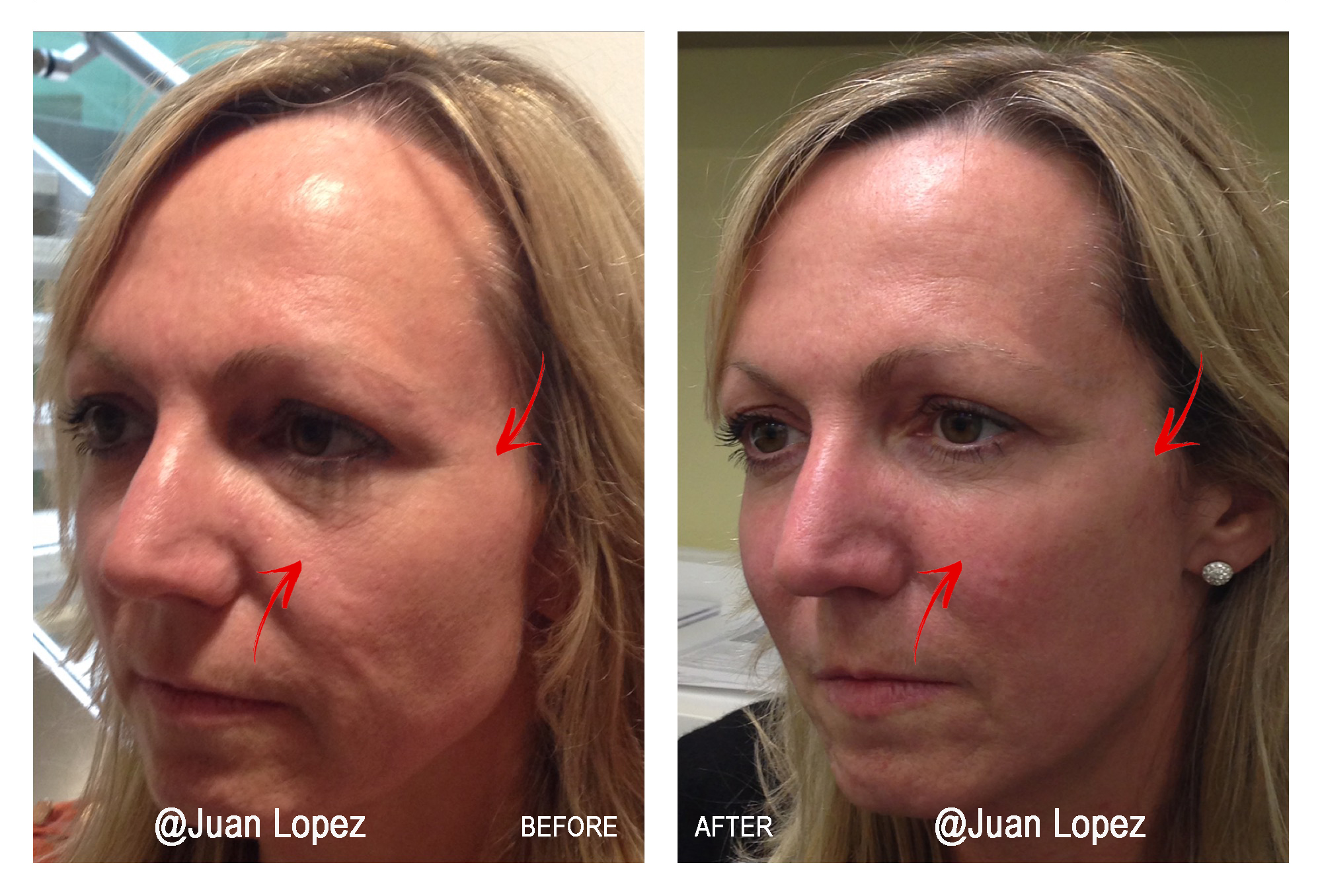 Cheek Enhancement - Dermal Filler - SkinMedico Clinic London