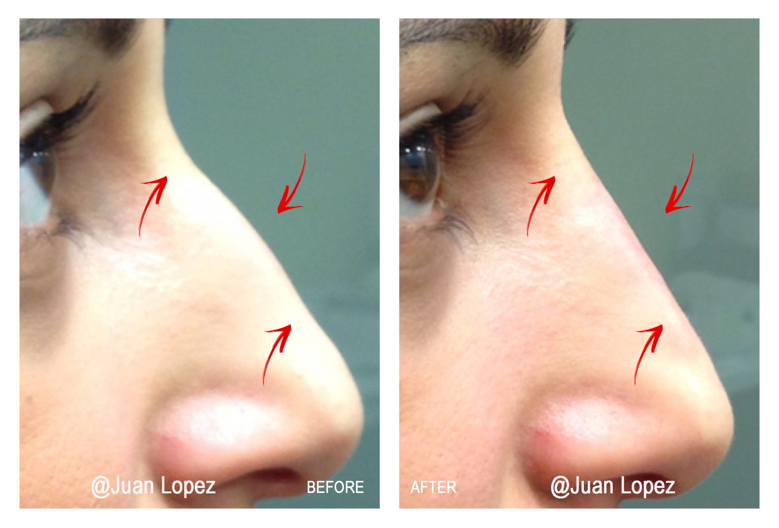Nose Reshaping - Dermal Filler - SkinMedico Clinic London