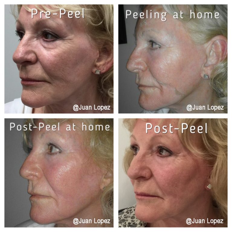 The Perfect Peel - SkinMedico Clinic London